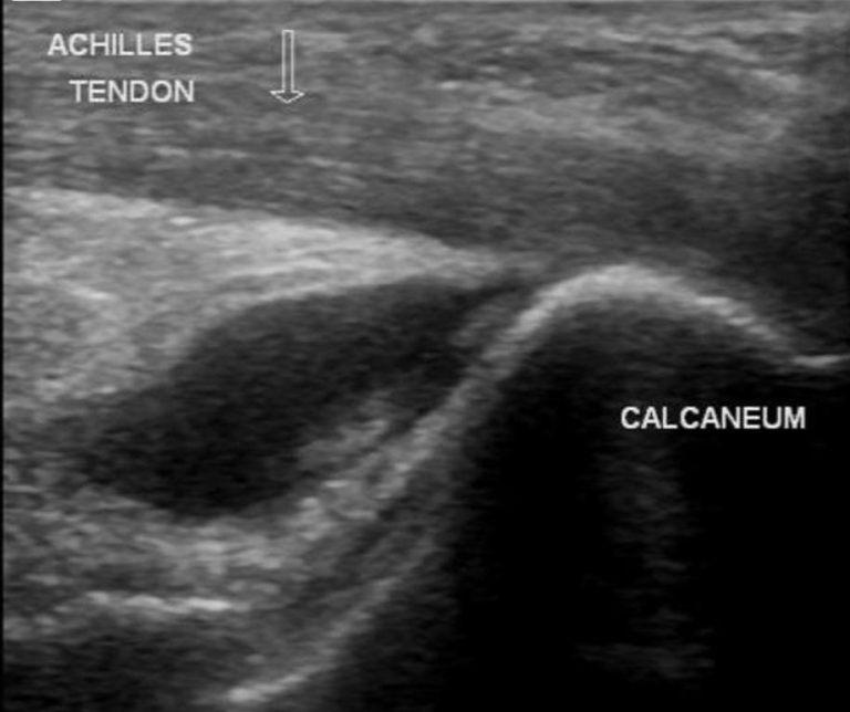 Borsite Retrocalcaneare - Nicola Liberati, Medico Chirurgo